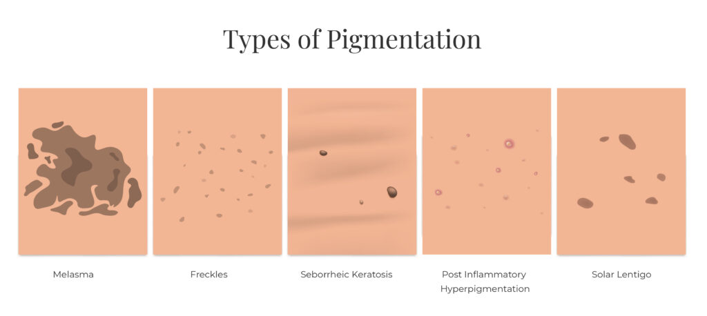 Pigmentation Archives - CS Medical Aesthetics Clinic